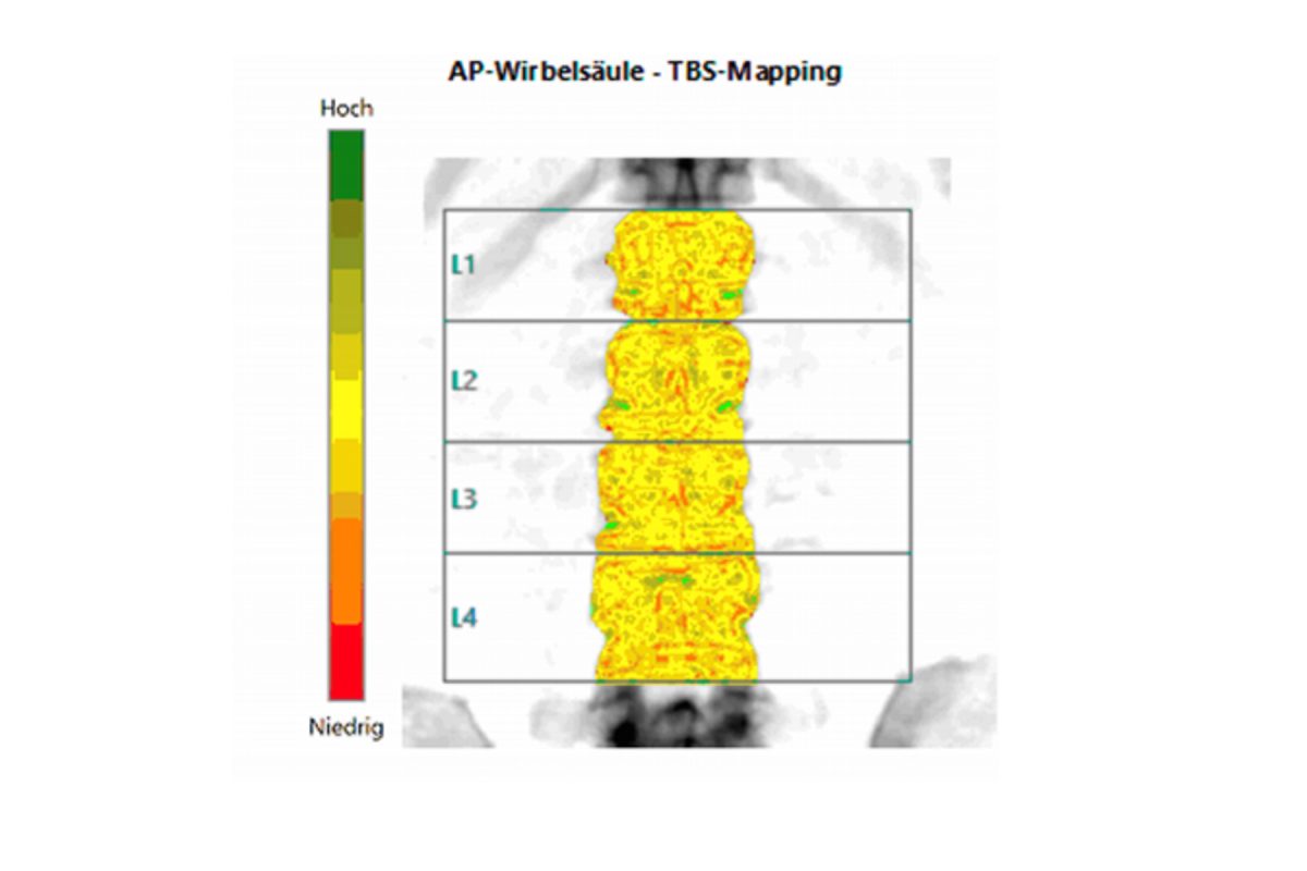 Trabecular Bone Score (TBS) – RNR